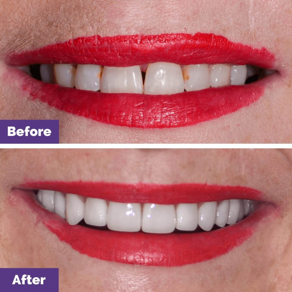 Combined Implant Veneer Case - Bacchus Marsh Dental House
