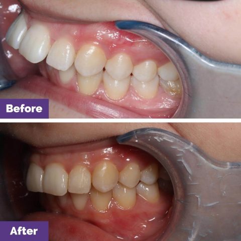 Invisalign Gap Closure Case - Bacchus Marsh Dental House
